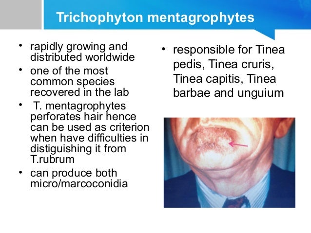 Trichophyton and Epidermophyton