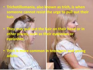 Trichotillomania.pptx | Skin and Dermatology | Diseases and Conditions