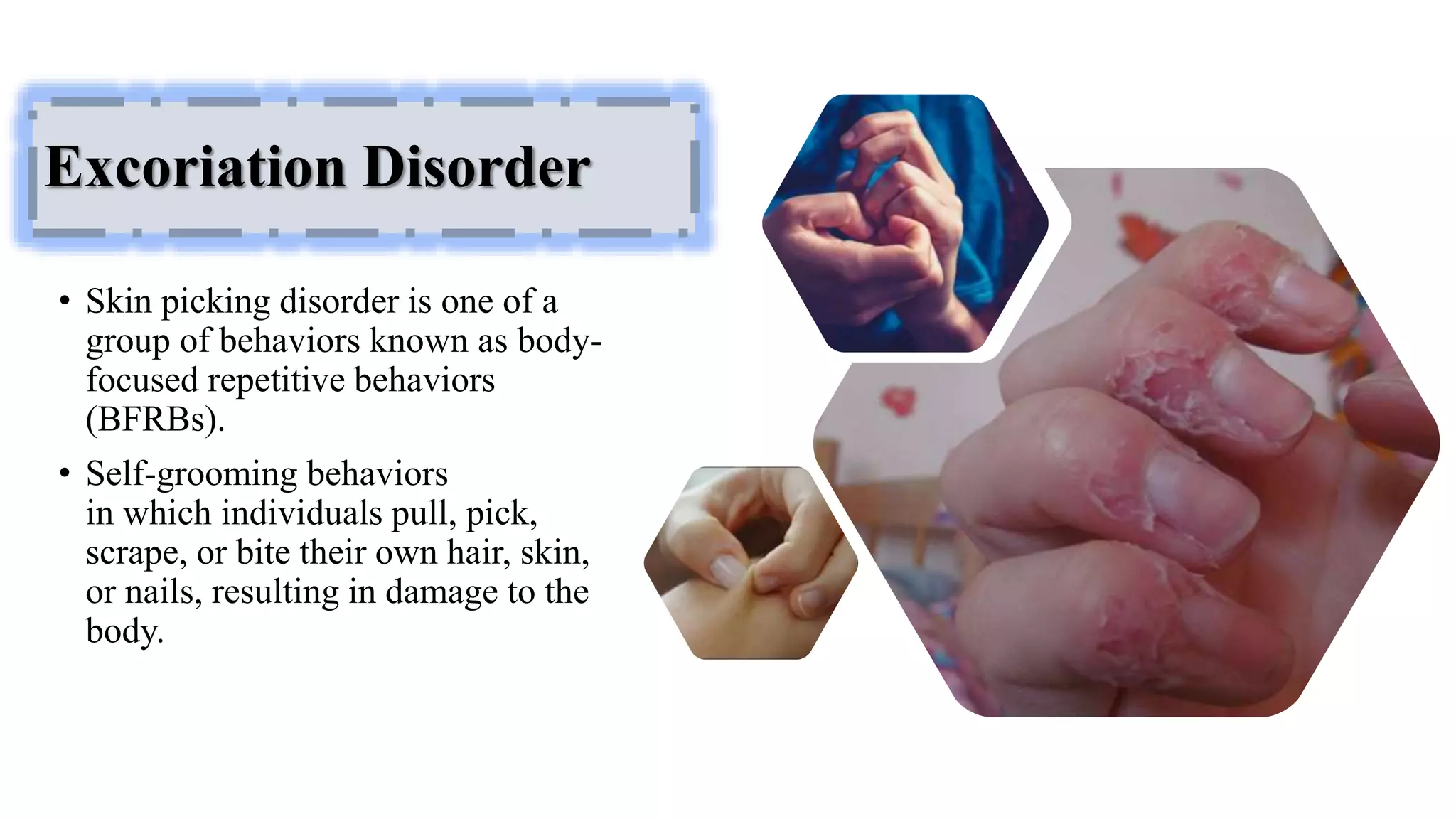 Trichotillomania and excoriation disorder | PPTX