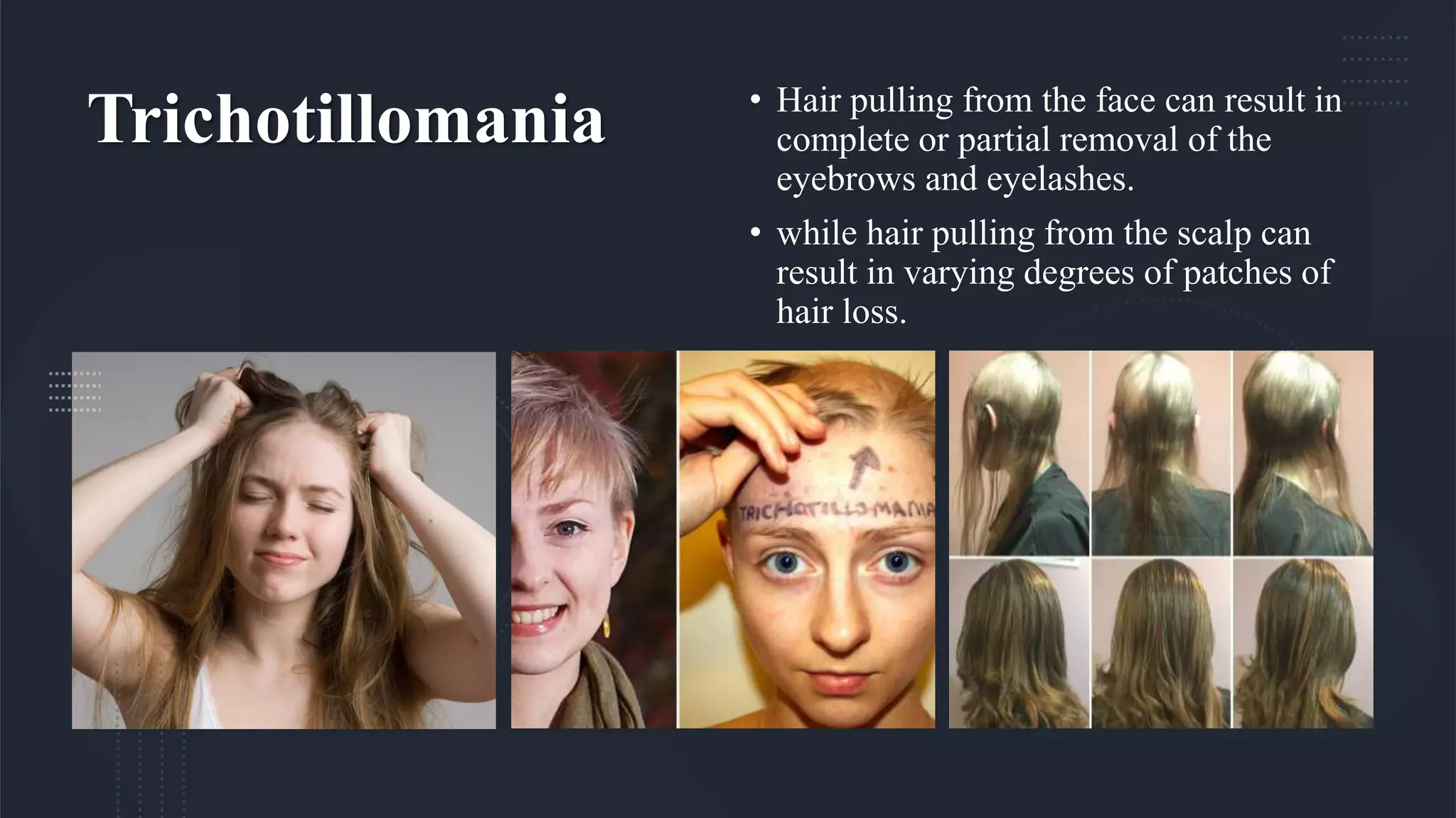 Trichotillomania and excoriation disorder | PPTX