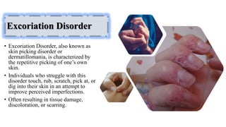 Trichotillomania and excoriation disorder | PPTX