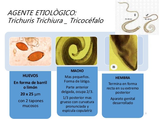 Trichuriasis o tricocefalosis