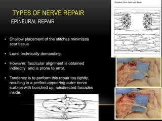Trick and tips of nerve repair | PDF