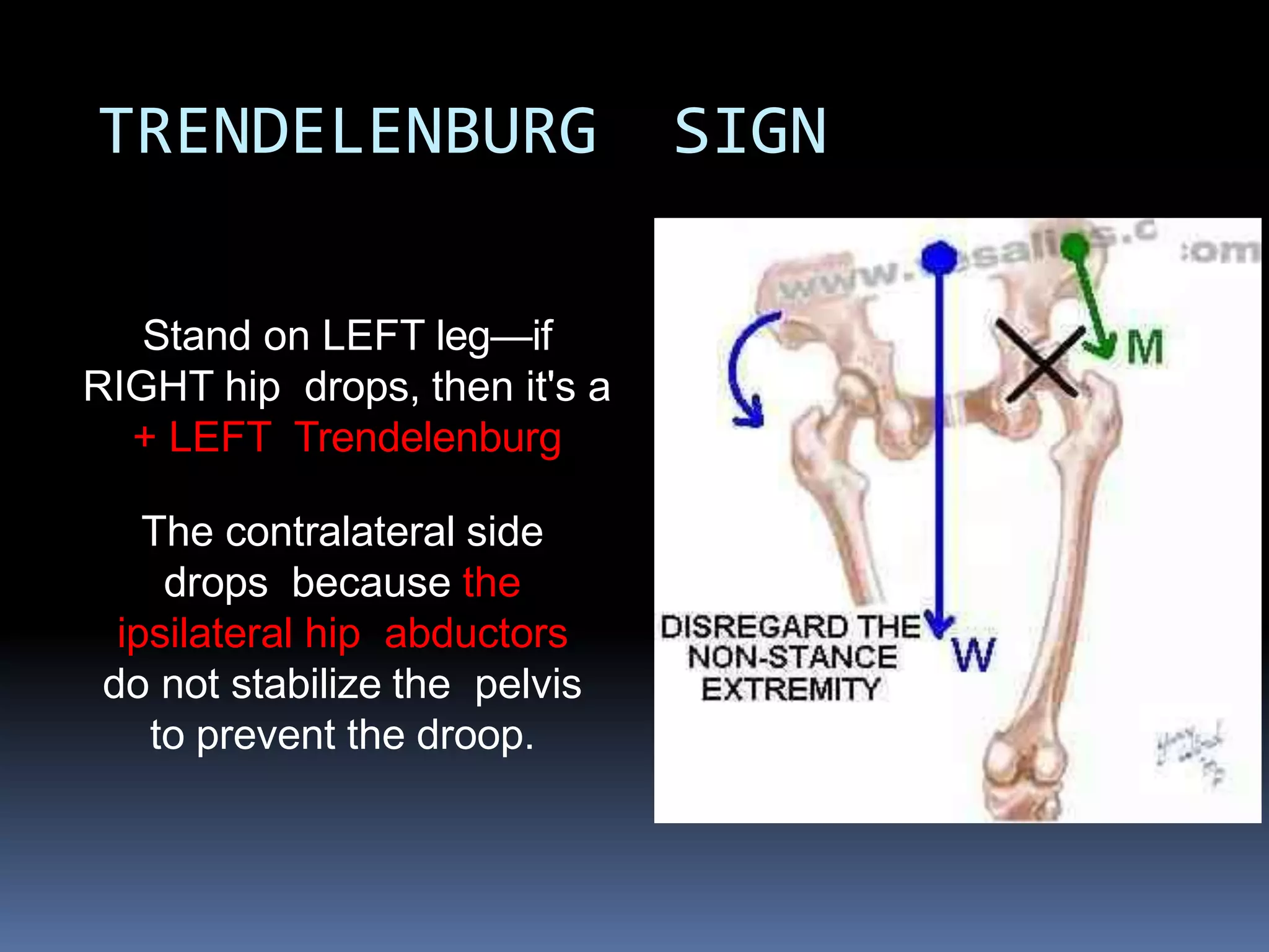 Trick movements of hip & pelvis | PPTX