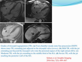 Tricuspid pulmonary valves | PPTX