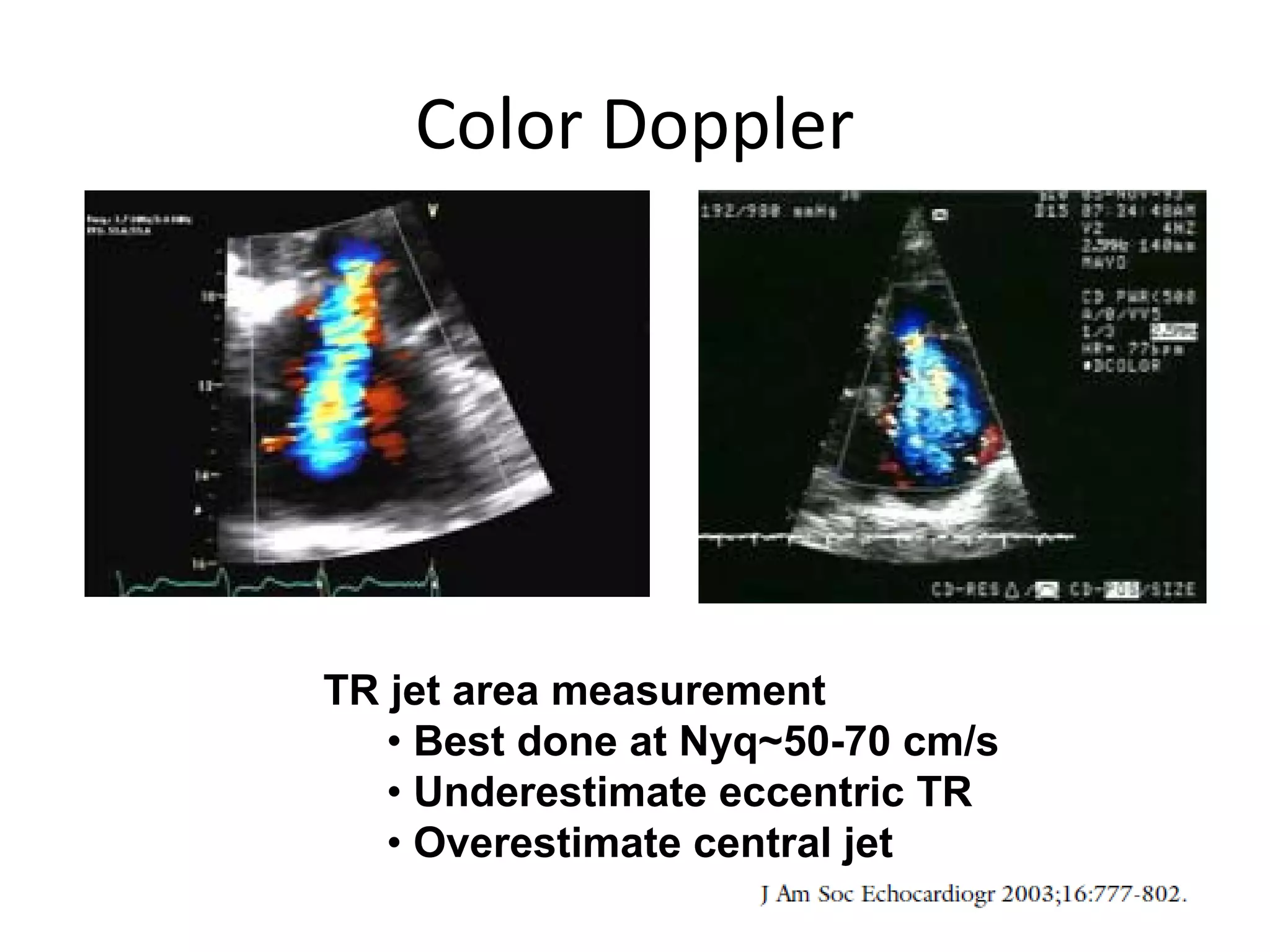 Tricuspid and pulmonic valves 2011 | PPT