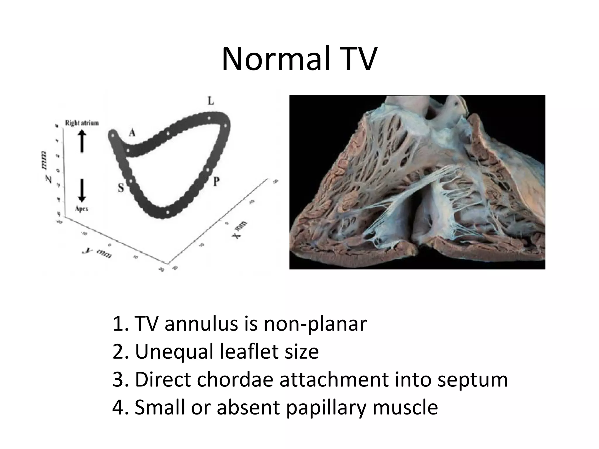 Tricuspid and pulmonic valves 2011 | PPT
