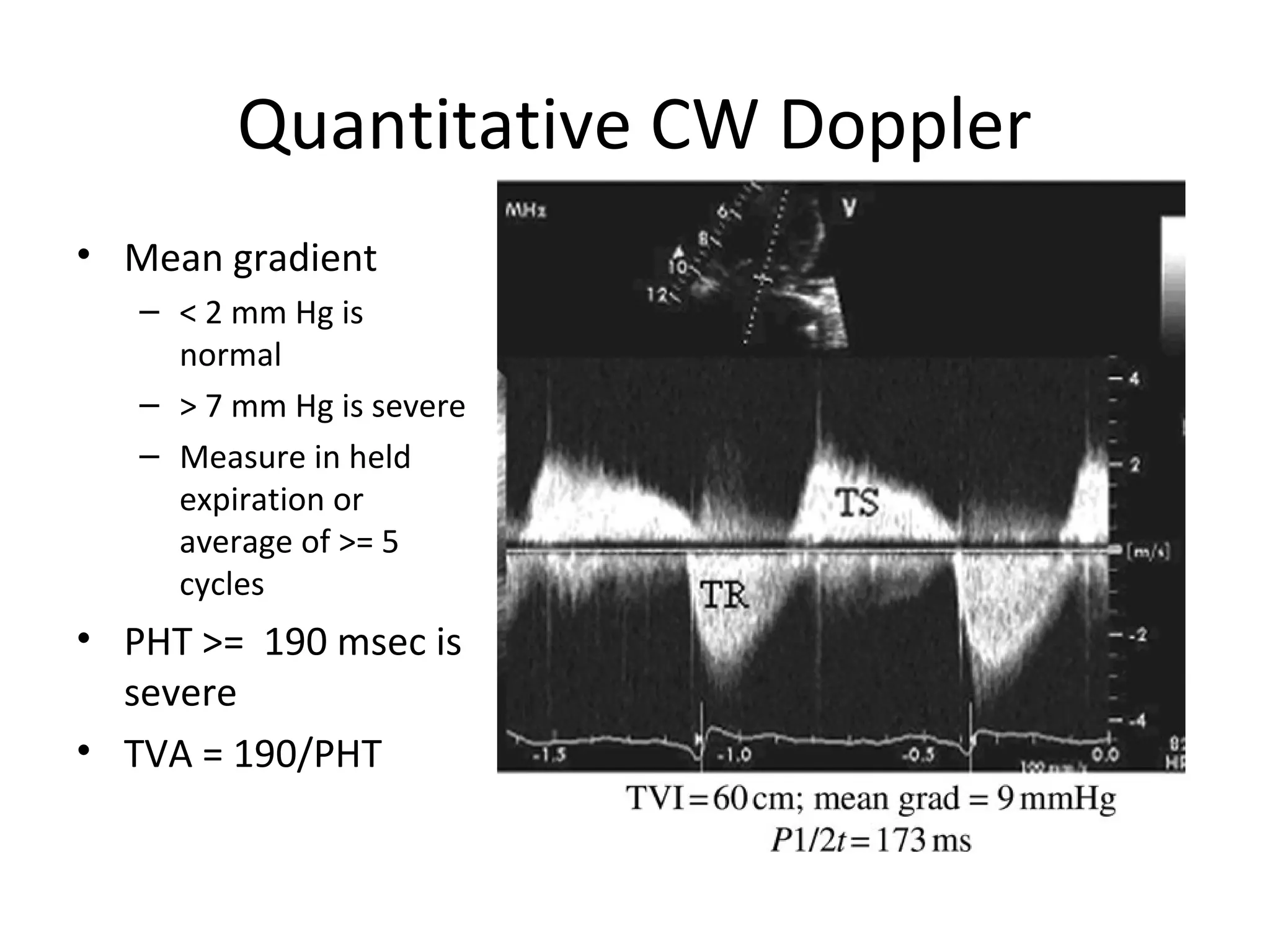 Tricuspid and pulmonic valves 2011 | PPT