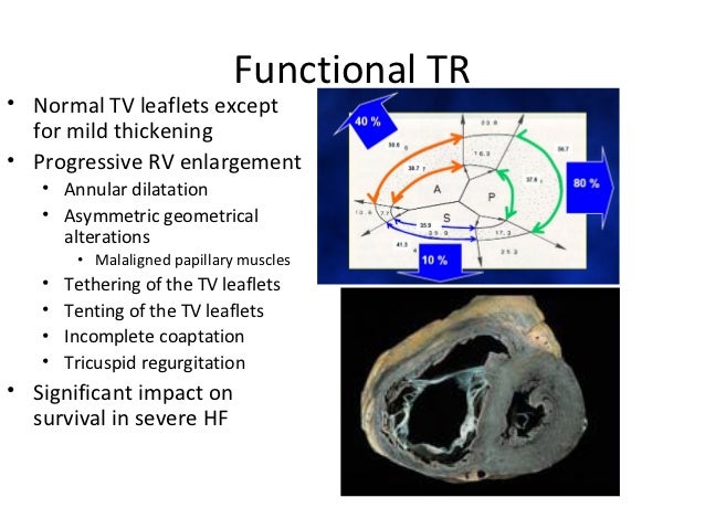 Tricuspid And Pulmonic Valves 2011