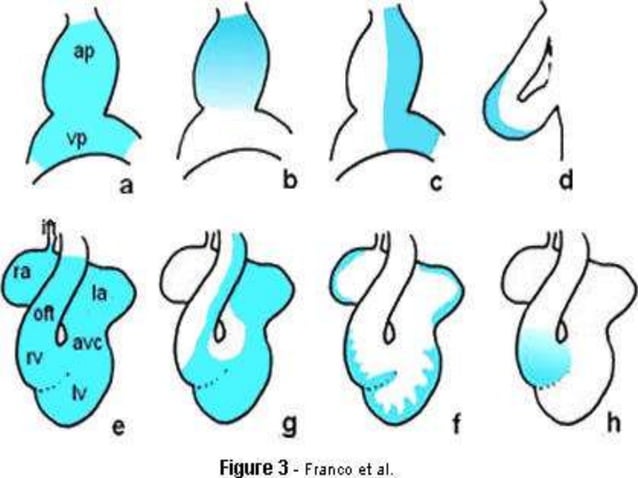 Tricuspid atresia in pediatrics | PPTX | Heart and Cardiovascular ...