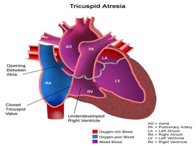Tricuspid atresia in pediatrics
