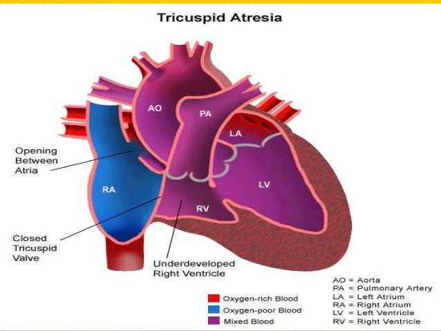 Tricuspid atresia in pediatrics