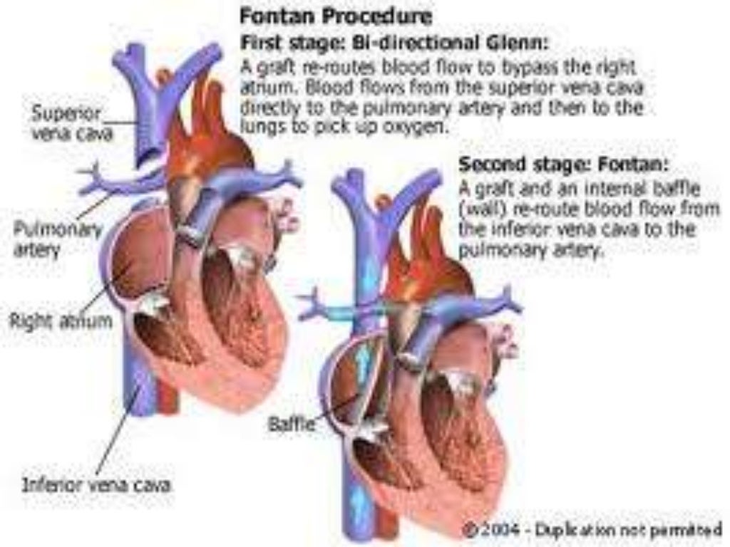 Tricuspid Atresia In Pediatrics