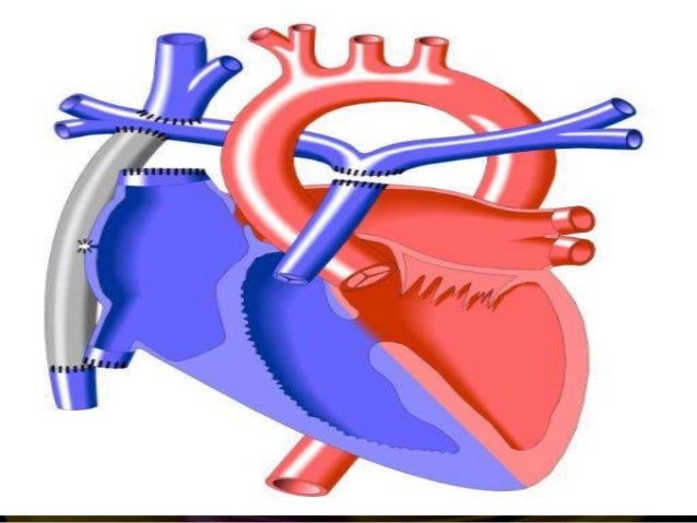 Tricuspid Atresia In Pediatrics