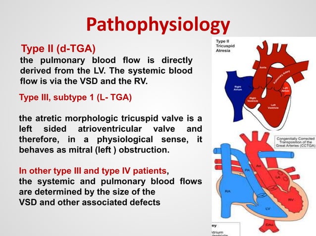 Tricuspid atresia | PPTX