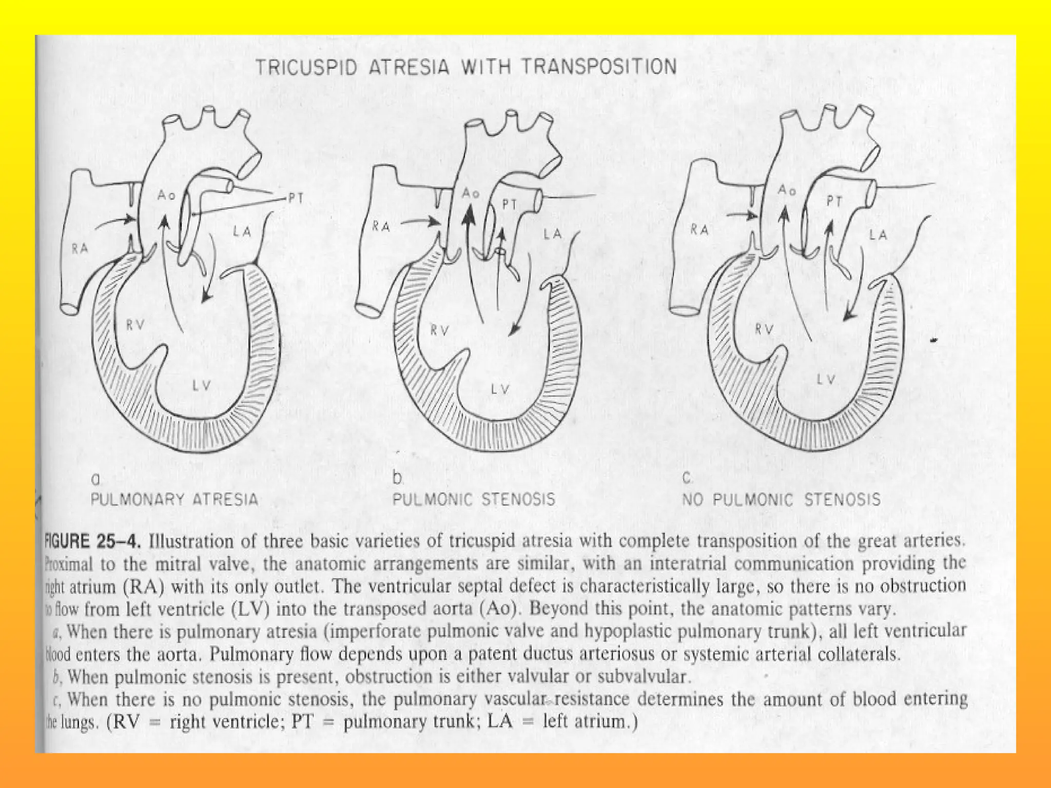 TRICUSPID ATRESIA (2).ppt,,,,,TRICUSPID ATRESIA (2).ppt