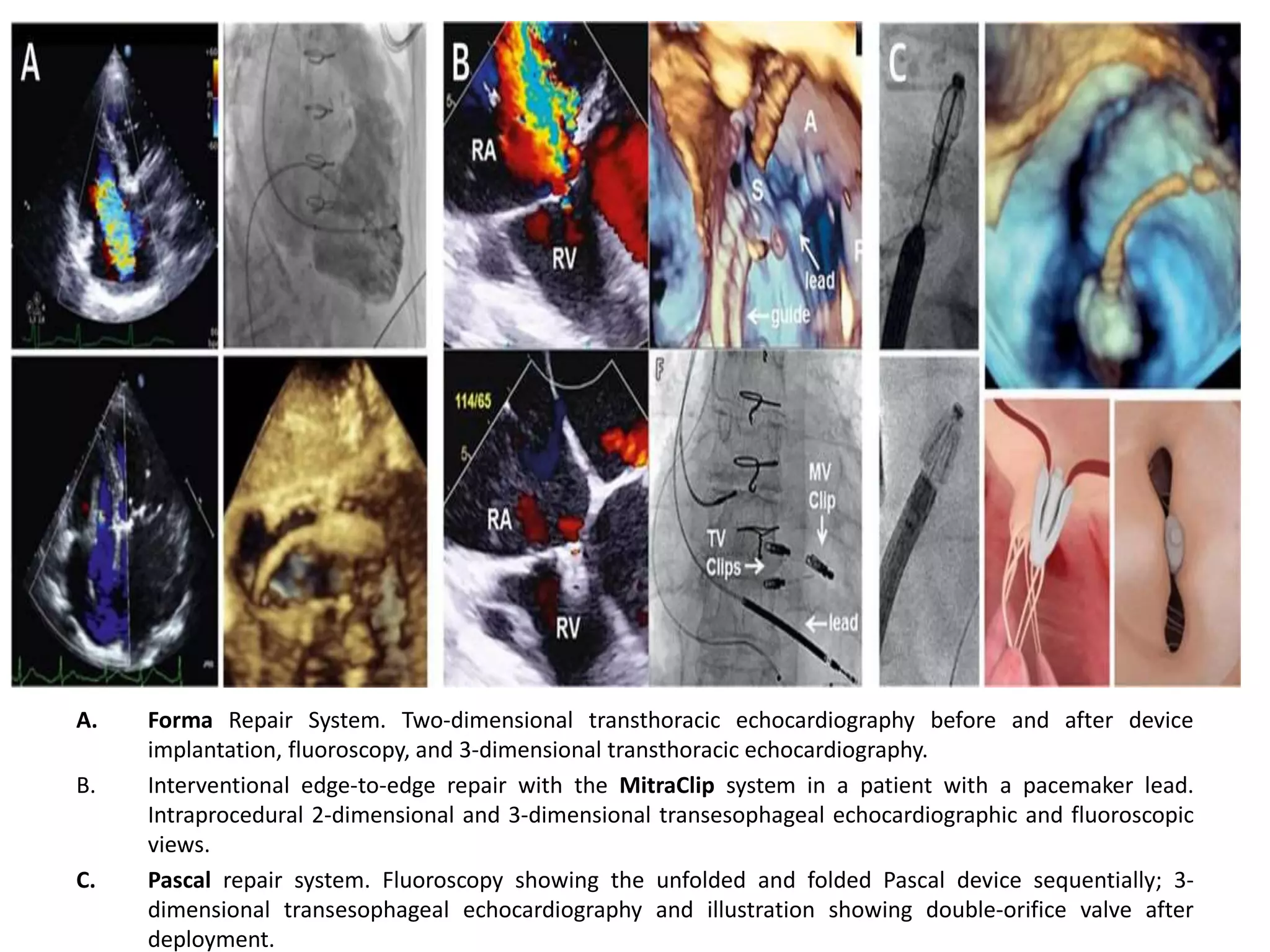 Tricuspid interventions | PPTX