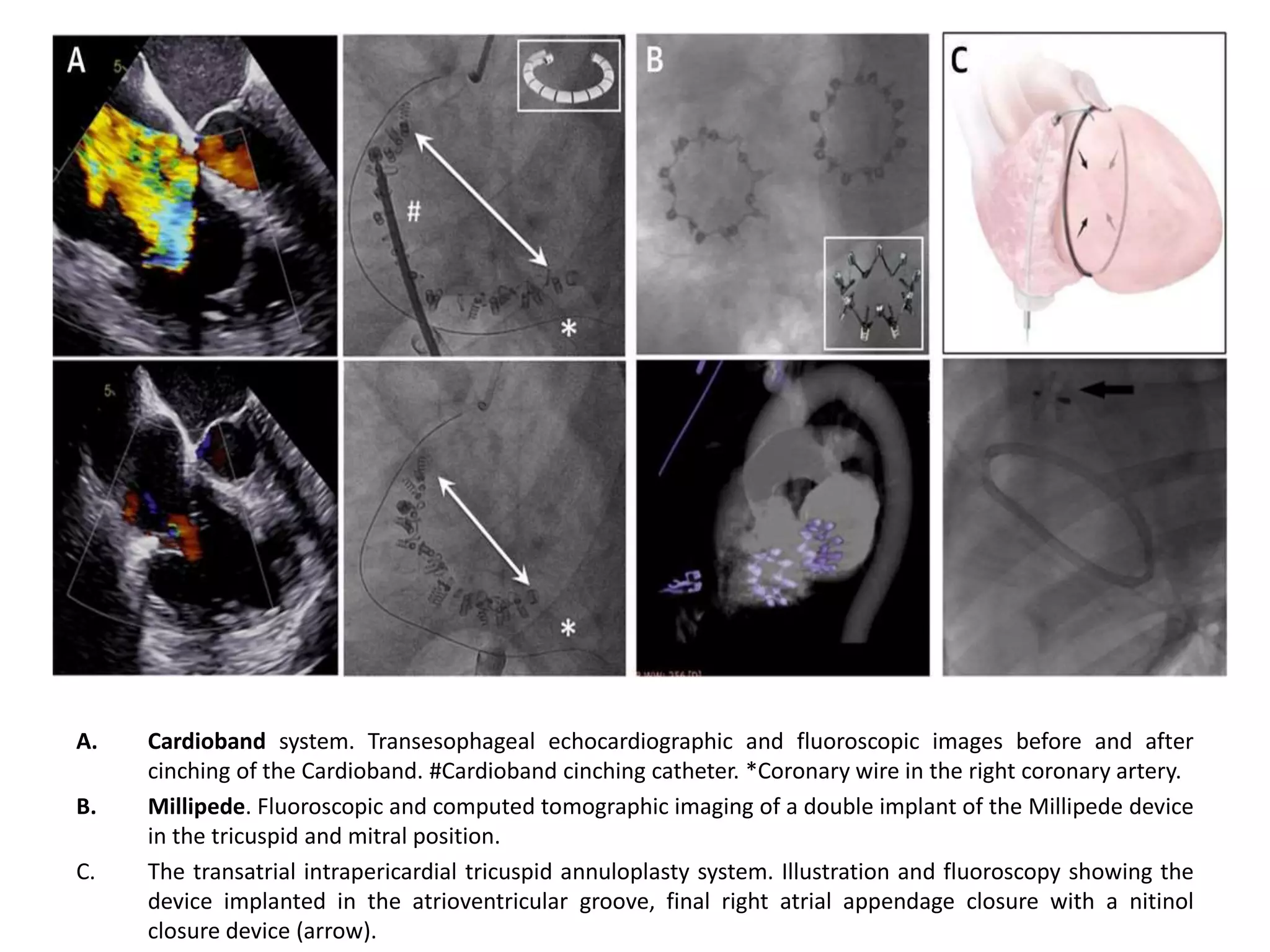 Tricuspid interventions | PPTX