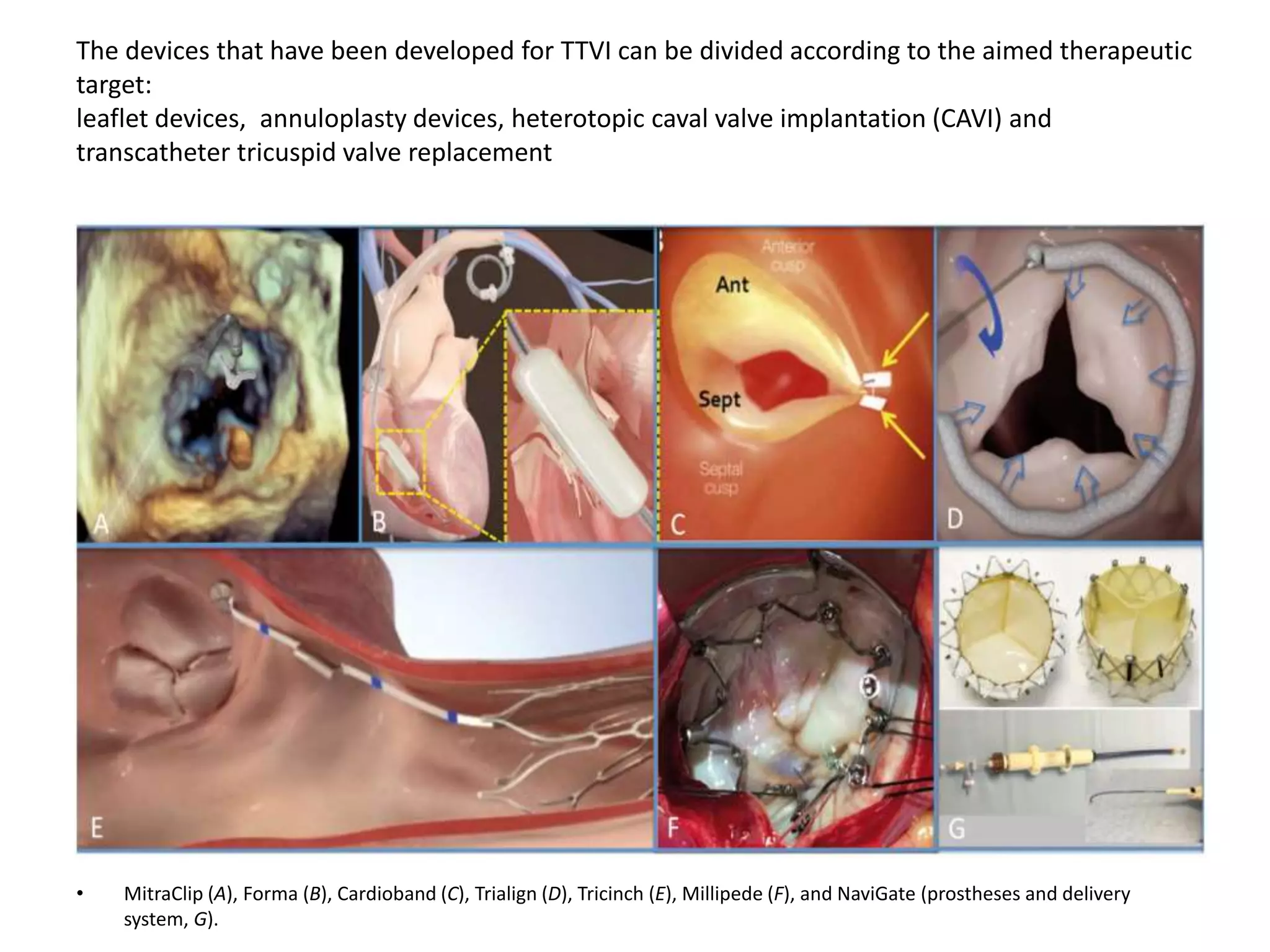 Tricuspid interventions | PPTX
