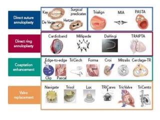 Tricuspid interventions | PPTX