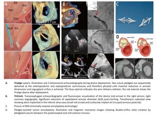 Tricuspid interventions | PPTX