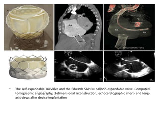 Tricuspid interventions | PPTX