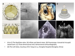 Tricuspid interventions | PPTX
