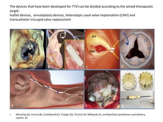 Tricuspid interventions | PPTX