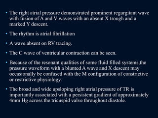 BACK TO BASICS - HEMODYNAMIC ROUNDS - TRICUSPID VALVE | PPTX
