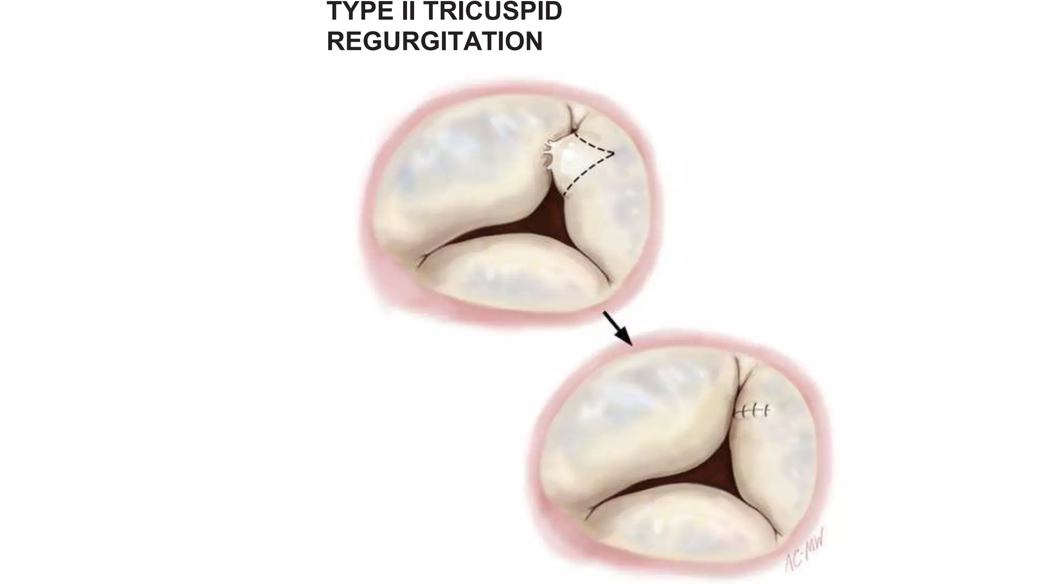 TRICUSPID VALVE ANATOMY PATHOPHYSIOLOGY INDICATIONS AND INTERVENTIONS.pptx