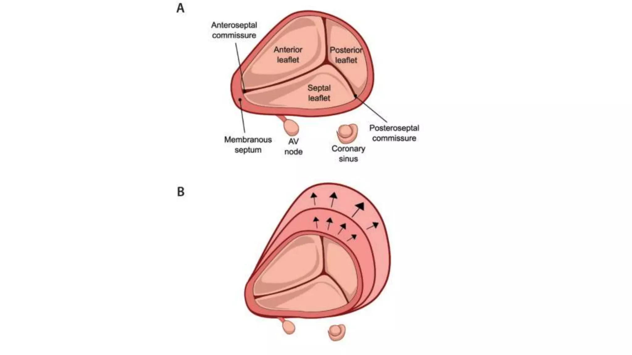 TRICUSPID VALVE ANATOMY PATHOPHYSIOLOGY INDICATIONS AND INTERVENTIONS.pptx