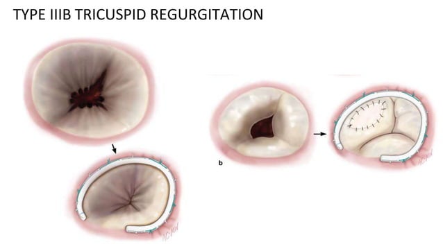 TRICUSPID VALVE ANATOMY PATHOPHYSIOLOGY INDICATIONS AND INTERVENTIONS.pptx