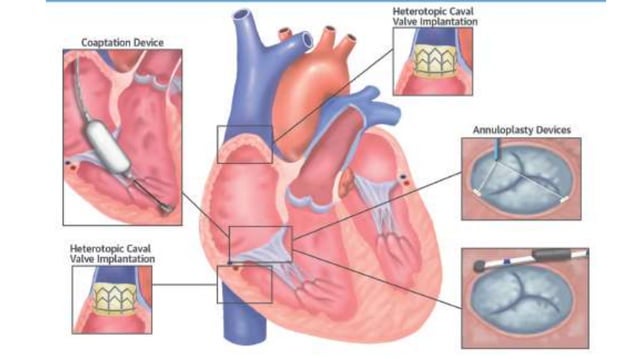 TRICUSPID VALVE ANATOMY PATHOPHYSIOLOGY INDICATIONS AND INTERVENTIONS.pptx