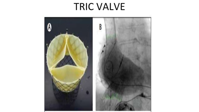 TRICUSPID VALVE ANATOMY PATHOPHYSIOLOGY INDICATIONS AND INTERVENTIONS.pptx
