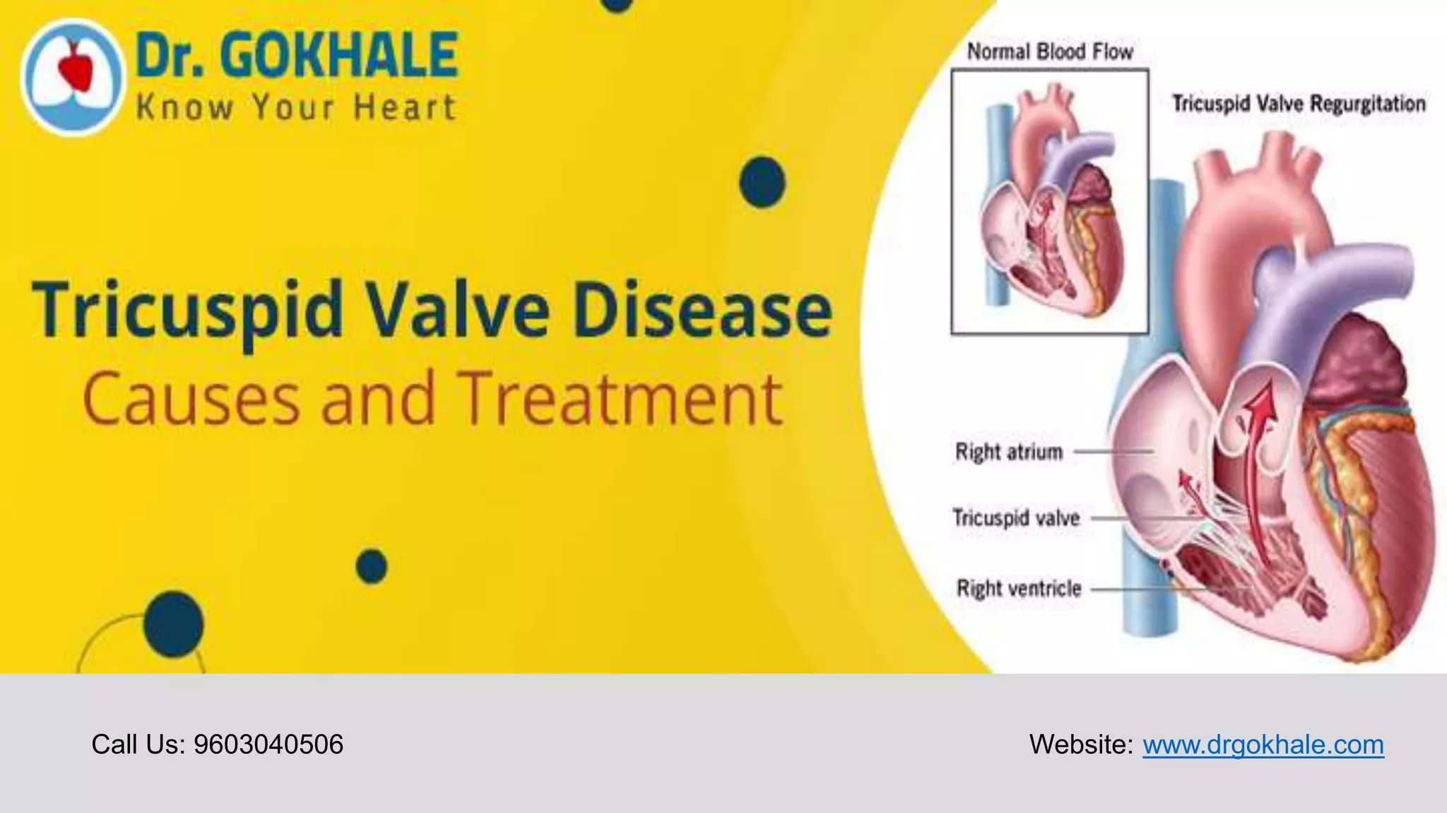 Tricuspid Valve Disease Causes And Treatment Dr Gokhale Ppt