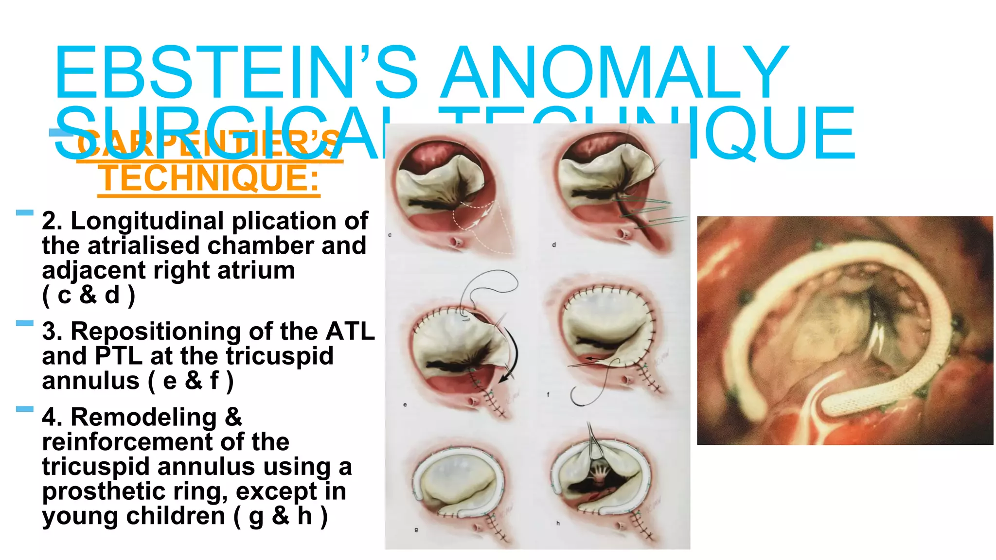 Tricuspid valve disease | PPTX