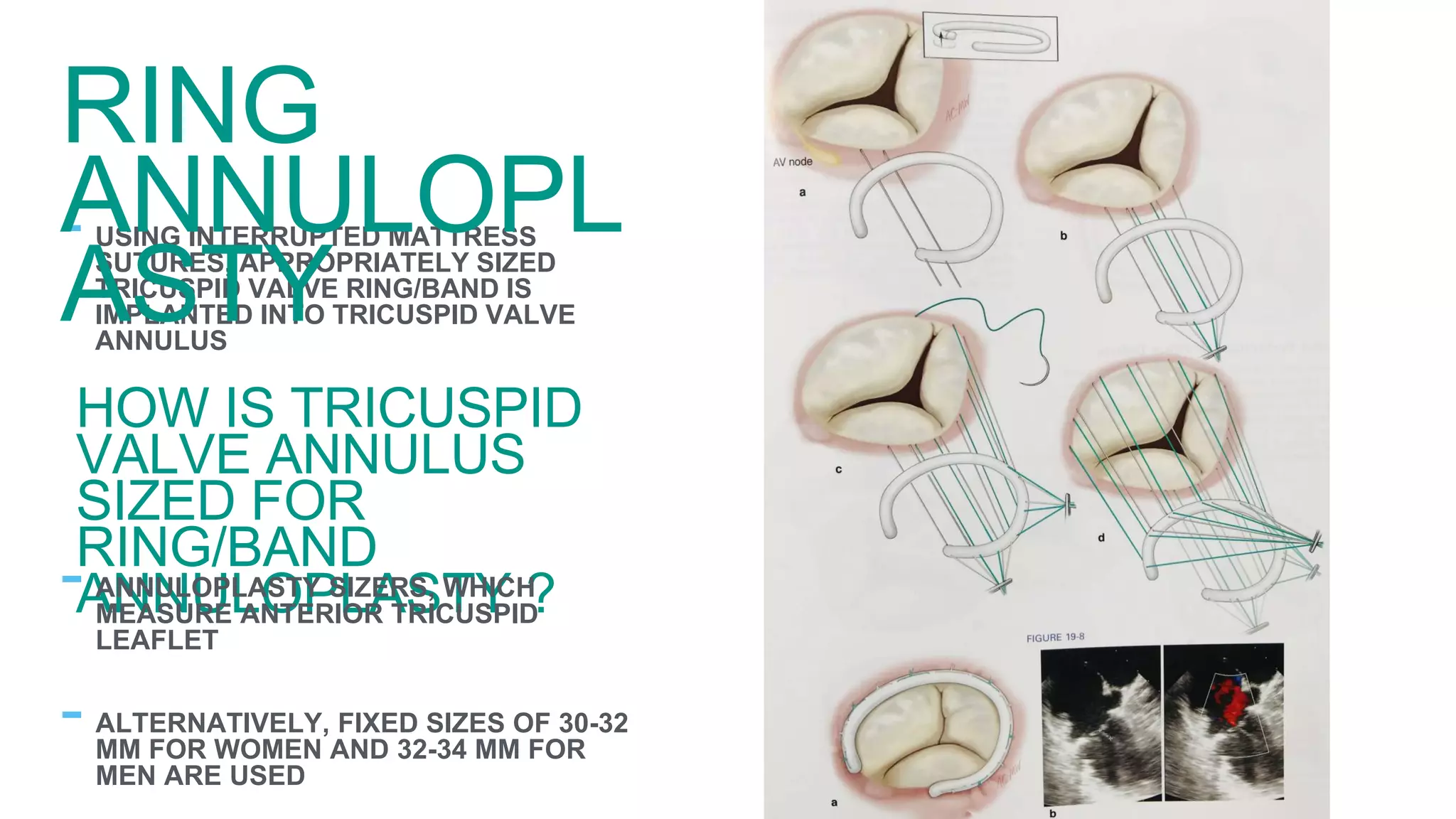 Tricuspid valve disease | PPTX