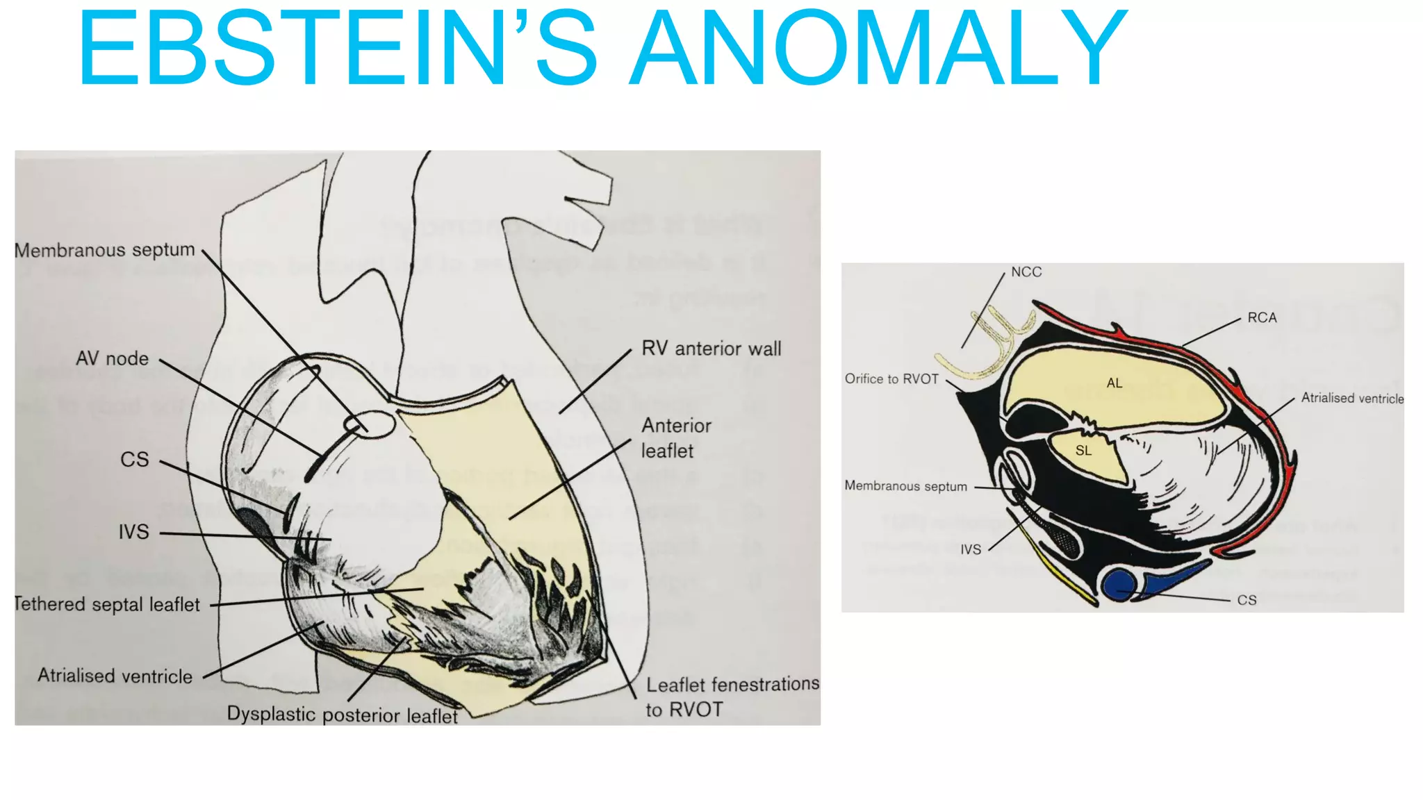 Tricuspid valve disease | PPTX