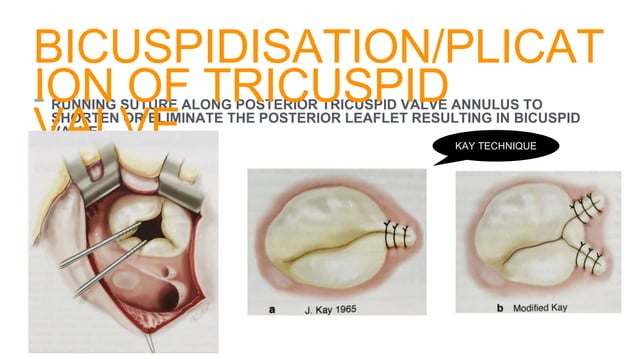 Tricuspid valve disease | PPTX | Heart and Cardiovascular Diseases ...