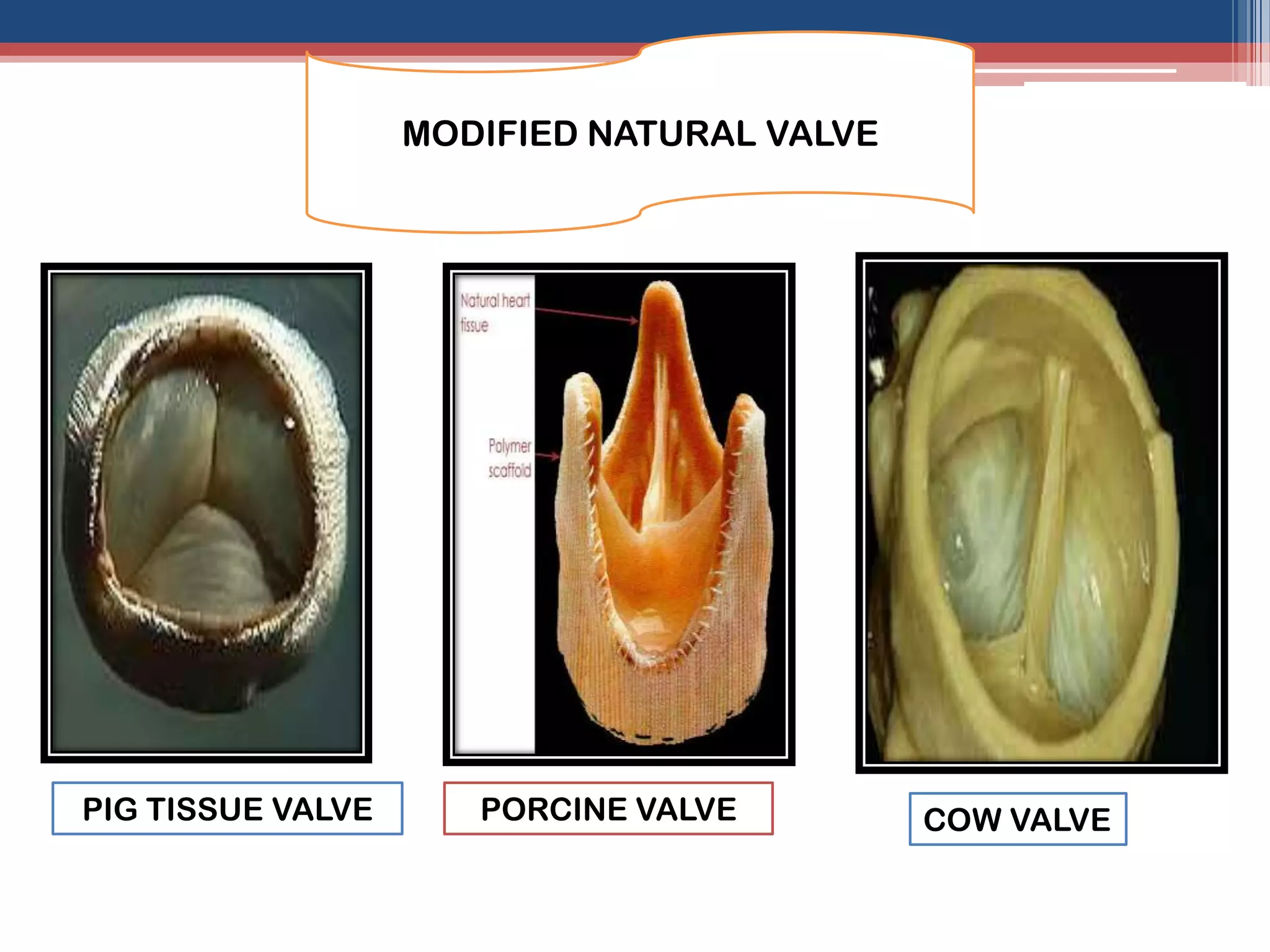 Tricuspid valve stenosis | PPTX