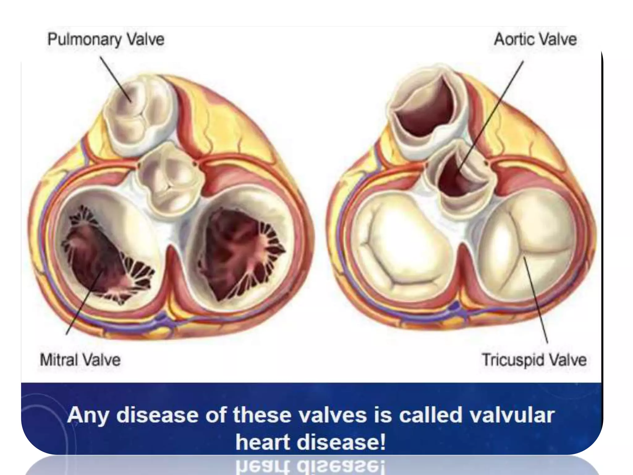 Tricuspid Valvular Heart Disease for post graduates | PPSX