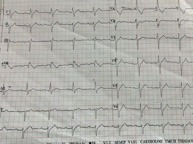 TRIFASCICULAR BLOCK - ECG Presentation.pptx