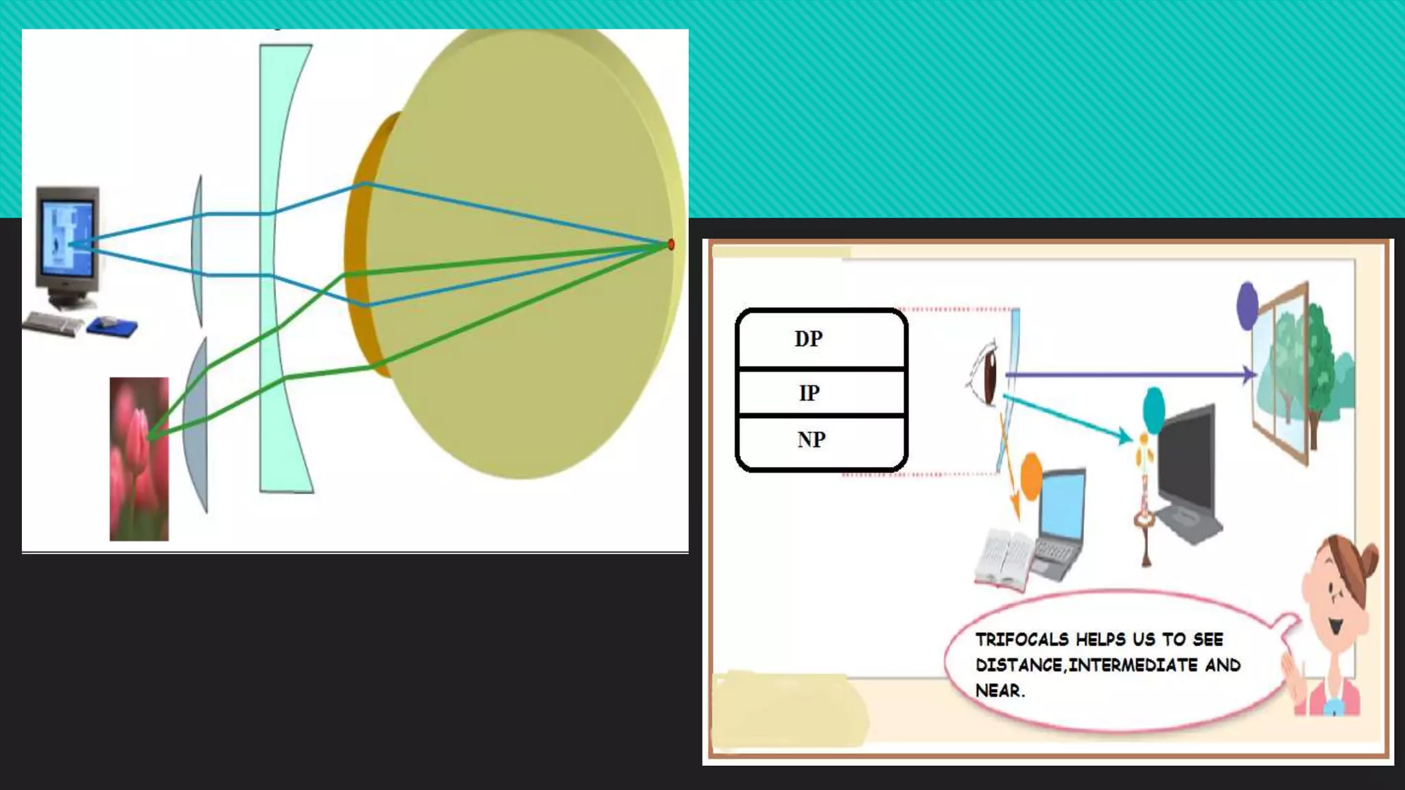Trifocals | PPTX