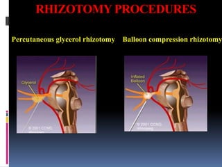 Trigeminal nerve, Glossopharyngeal and Hypoglossal nerves | PPTX