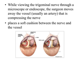 Trigeminal nerve applied anatomy(part 2) | PPT