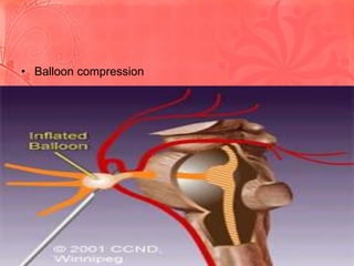 Trigeminal neuralgia | PPTX