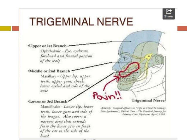 Trigeminal Neuralgia