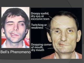 Trigeminal neuralgia | PPTX