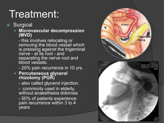 Trigeminal neuralgia | PPTX