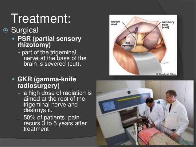 Trigeminal neuralgia